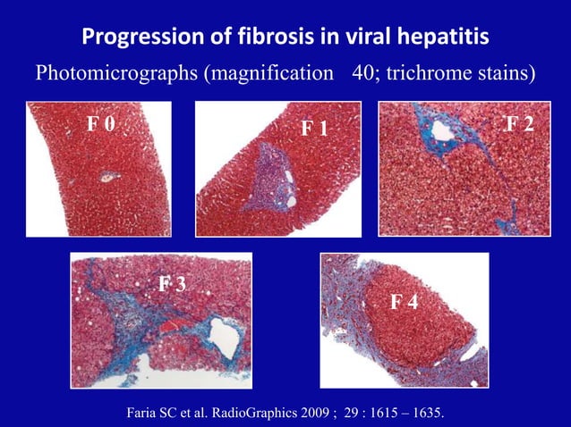 Liver stiffness measurement (fibroscan®) | PPTX