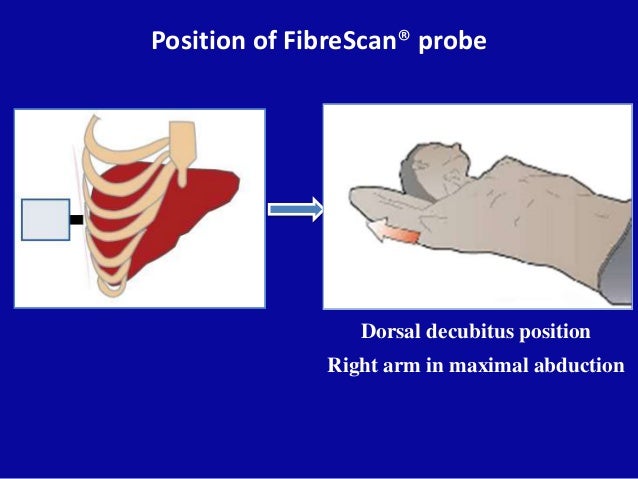 Liver stiffness measurement (fibroscan®)