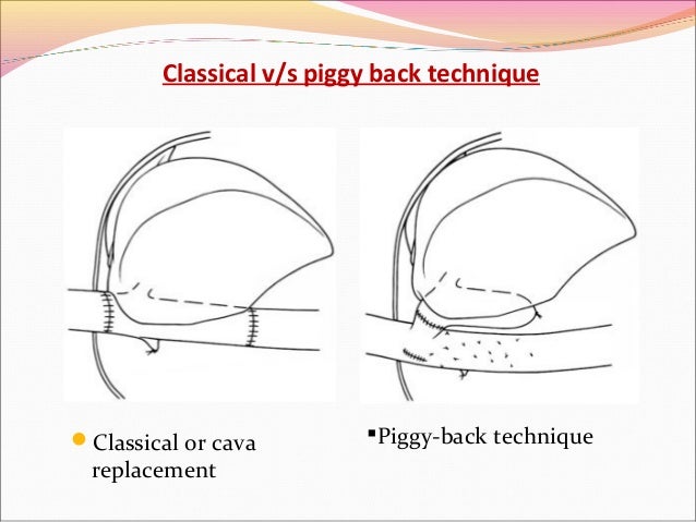 Liver transplantation - workshop