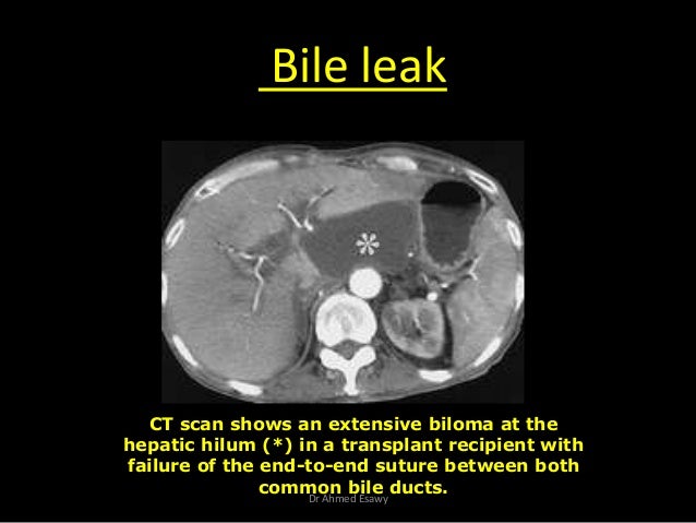 Imaging Liver transplantation post operative Dr Ahmed Esawy