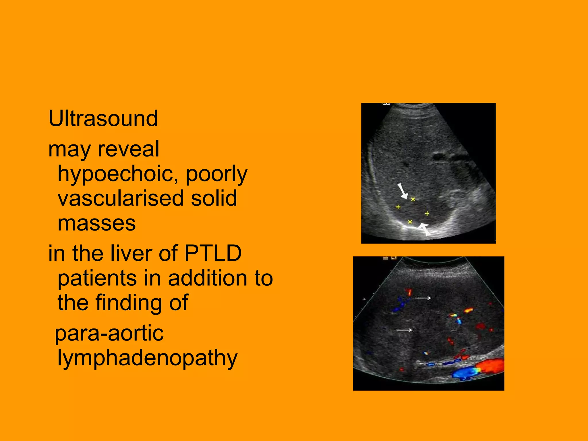 Liver transplant evaluation | PPT