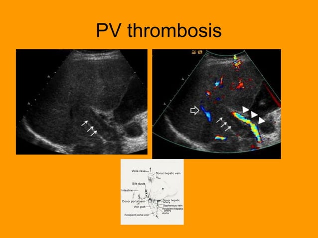 Liver transplant evaluation | PPT