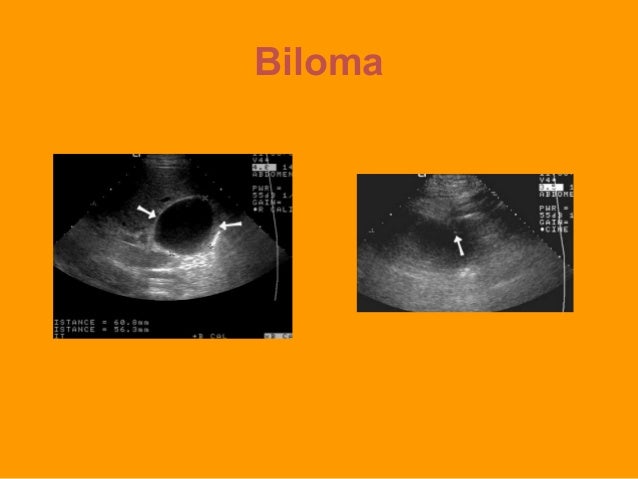 Liver transplant evaluation