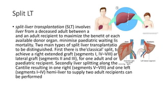 Liver transplant lec 1.dr quiyum | PPT