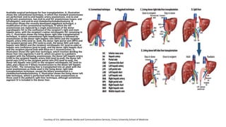 Liver transplant lec 2.dr quiyum | PPTX | Surgery | Medical Health