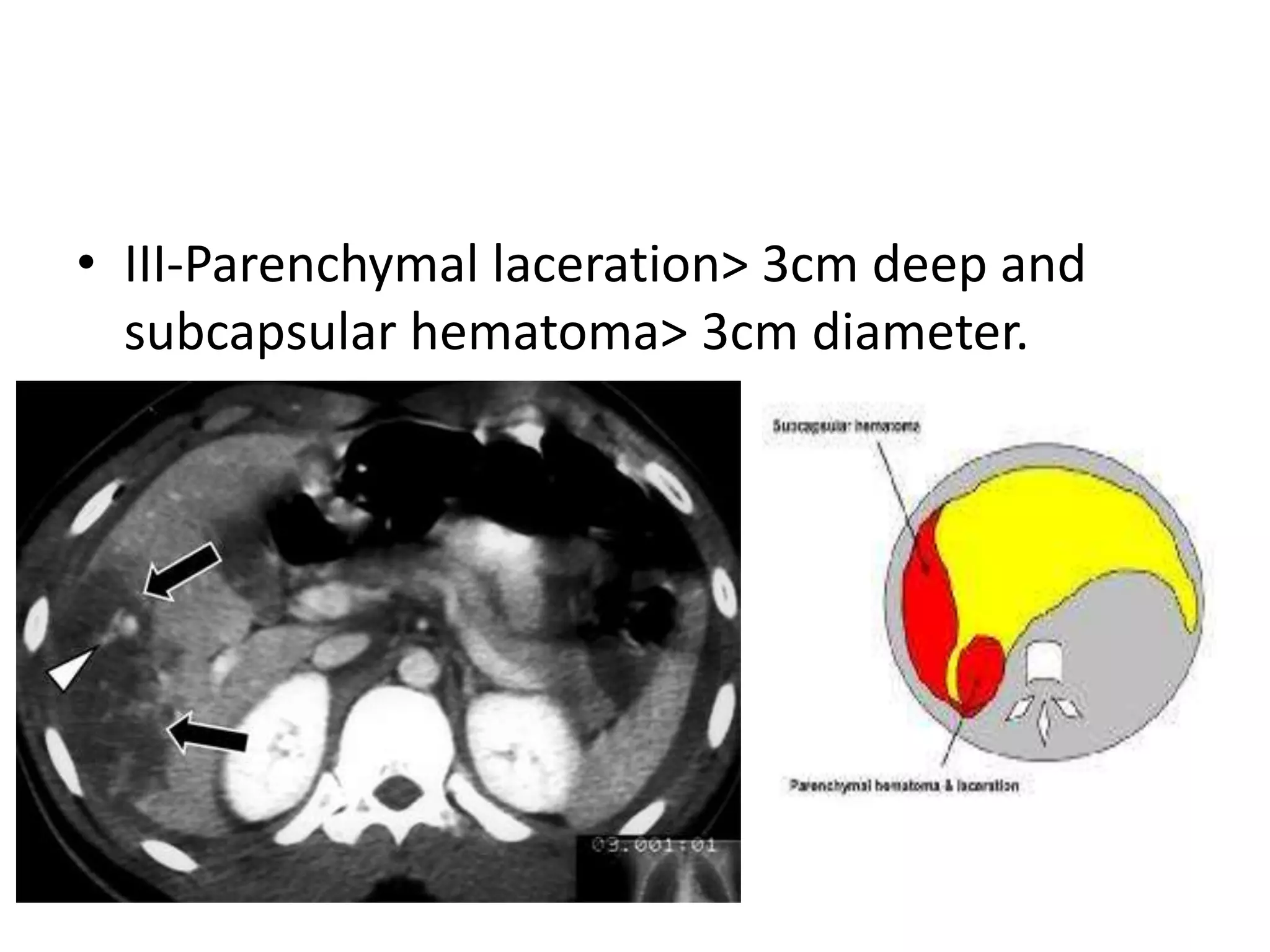 Liver trauma: A comprehensive review of classification, mechanisms ...