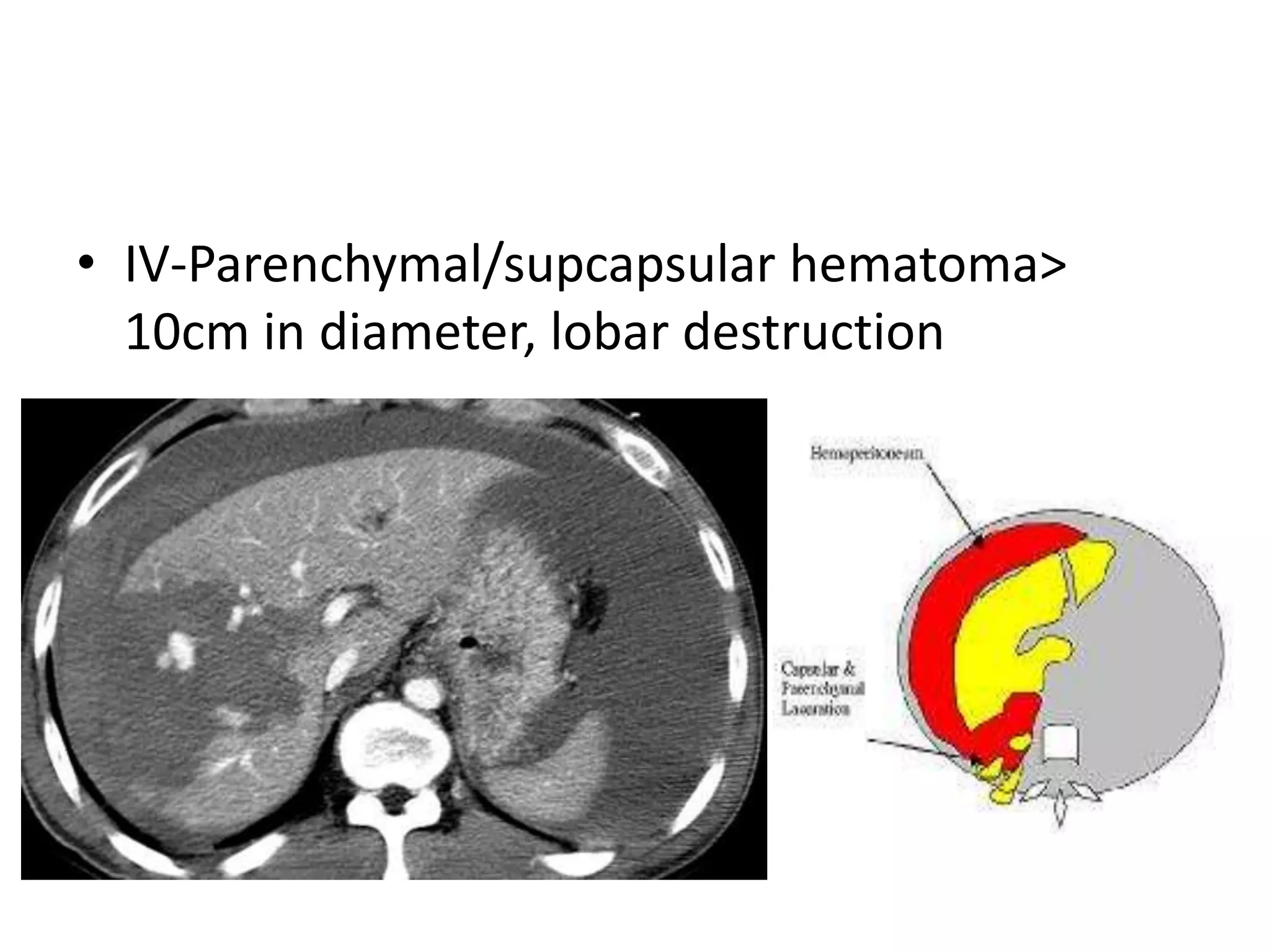 Liver trauma: A comprehensive review of classification, mechanisms ...