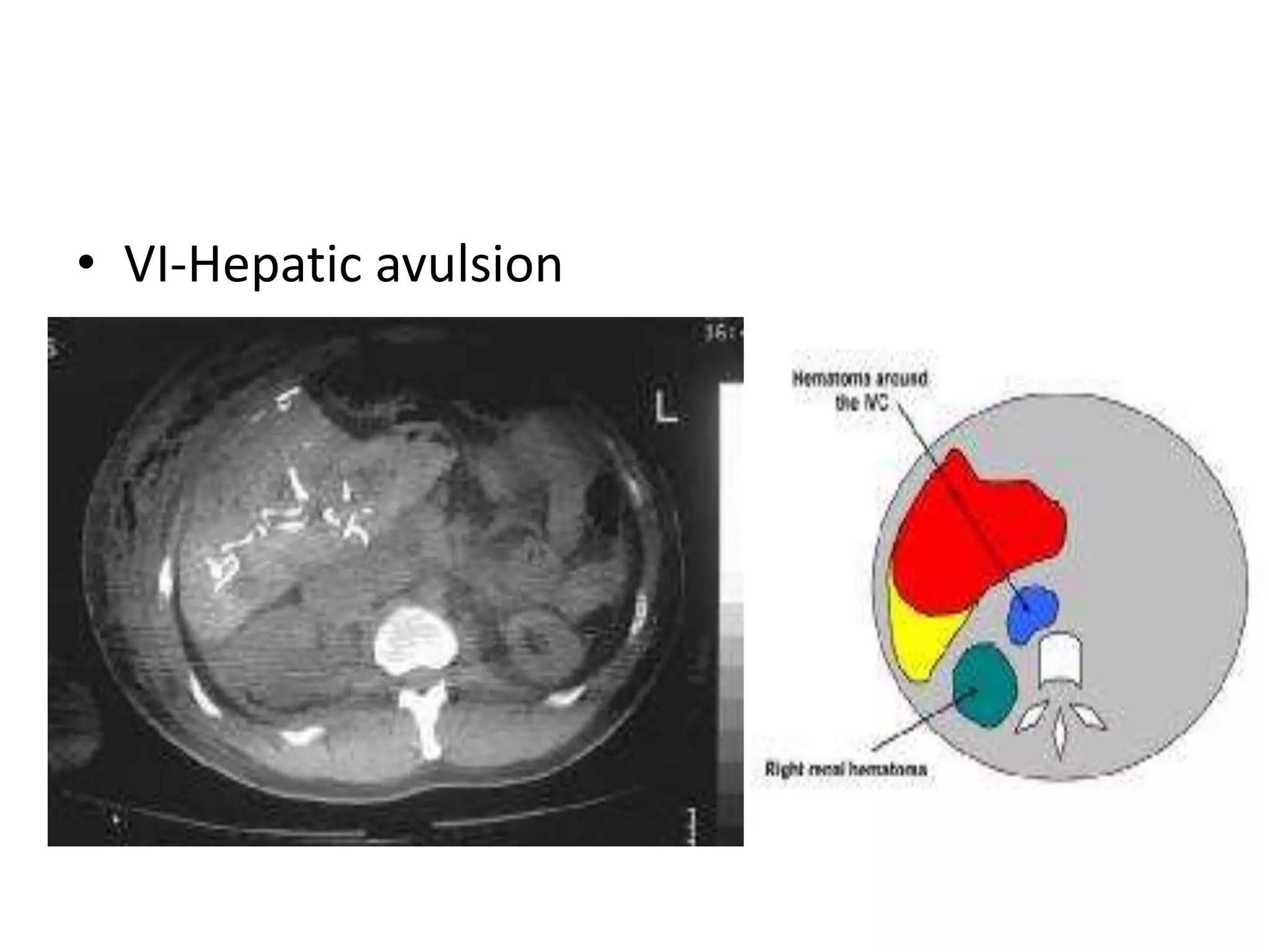 Liver trauma: A comprehensive review of classification, mechanisms ...