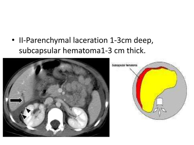 Liver trauma: A comprehensive review of classification, mechanisms ...