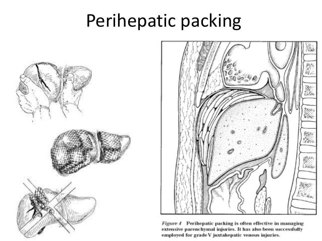 Liver trauma: A comprehensive review of classification, mechanisms, e…