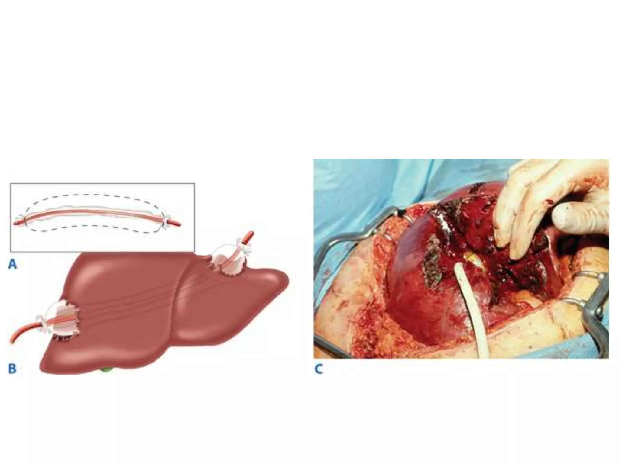 Liver trauma | PPTX
