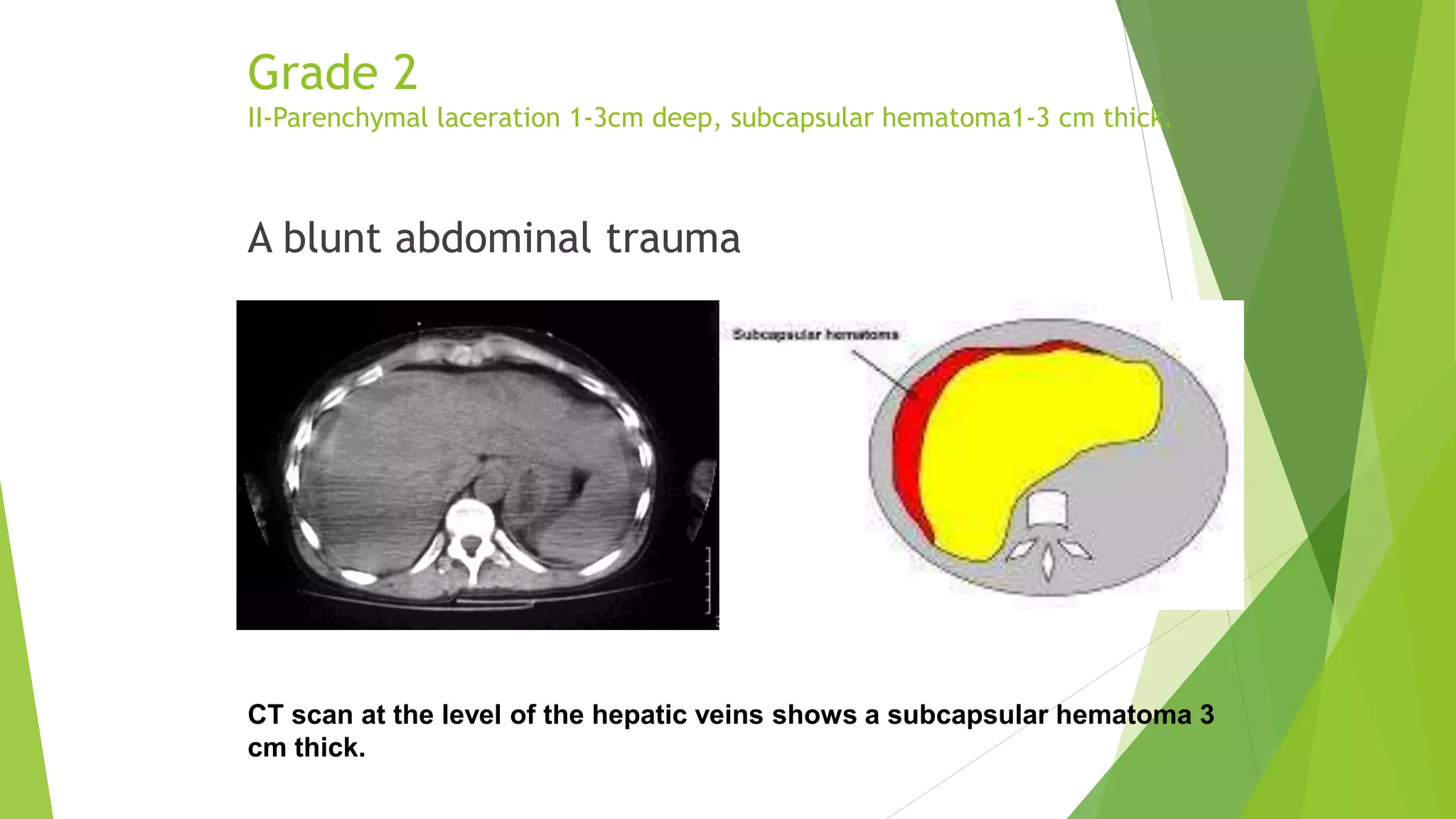 Liver trauma | PPTX
