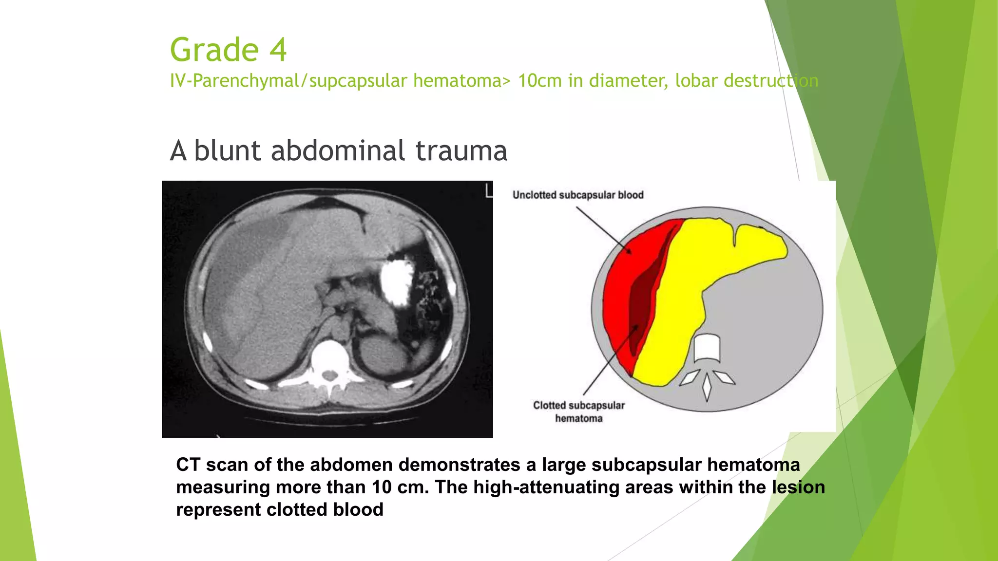 Liver trauma | PPTX