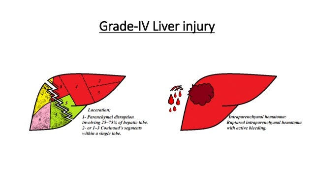 Liver trauma الدكتور طارق المنيزل