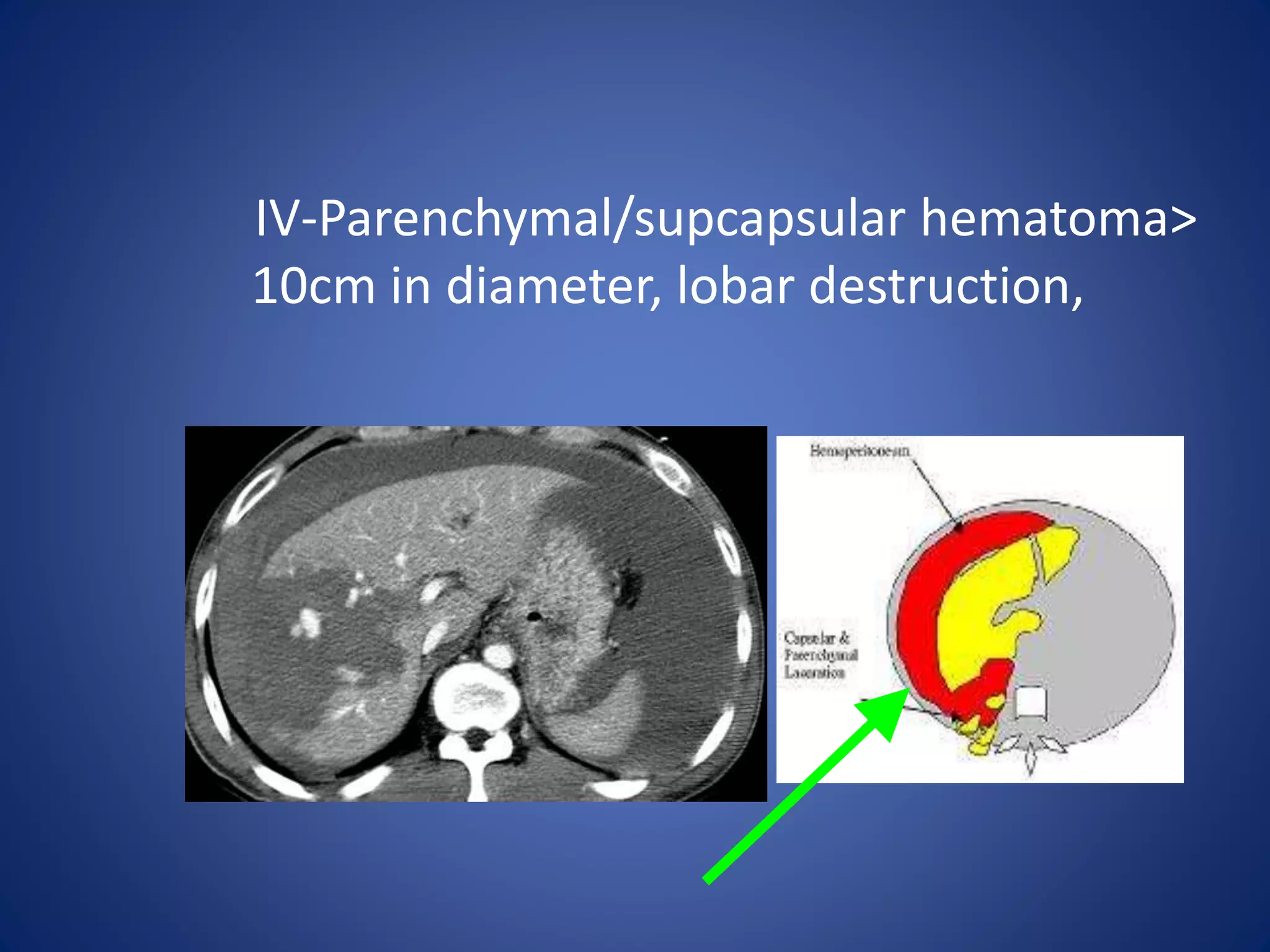 Liver trauma | PPTX