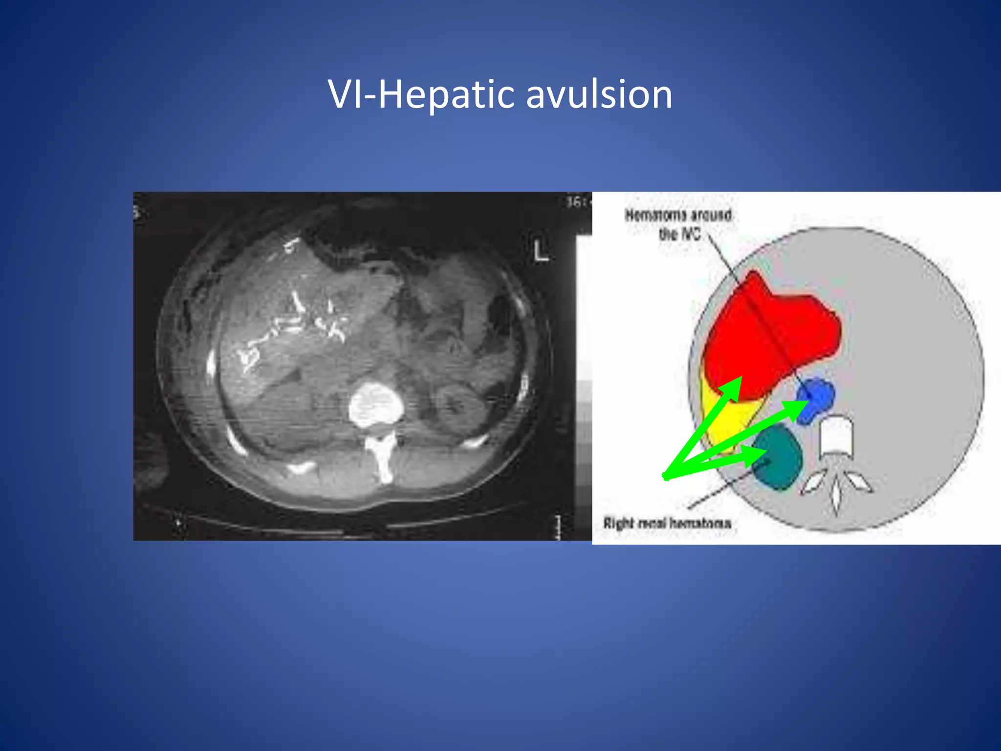 Liver trauma | PPTX