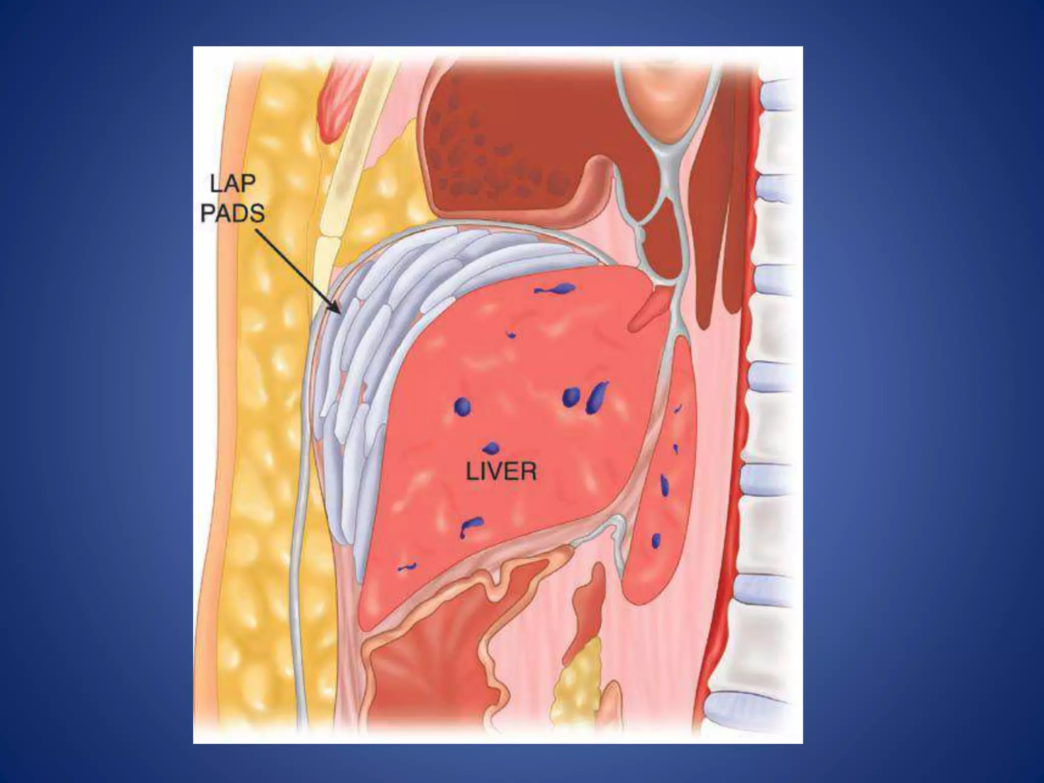 Liver trauma | PPTX