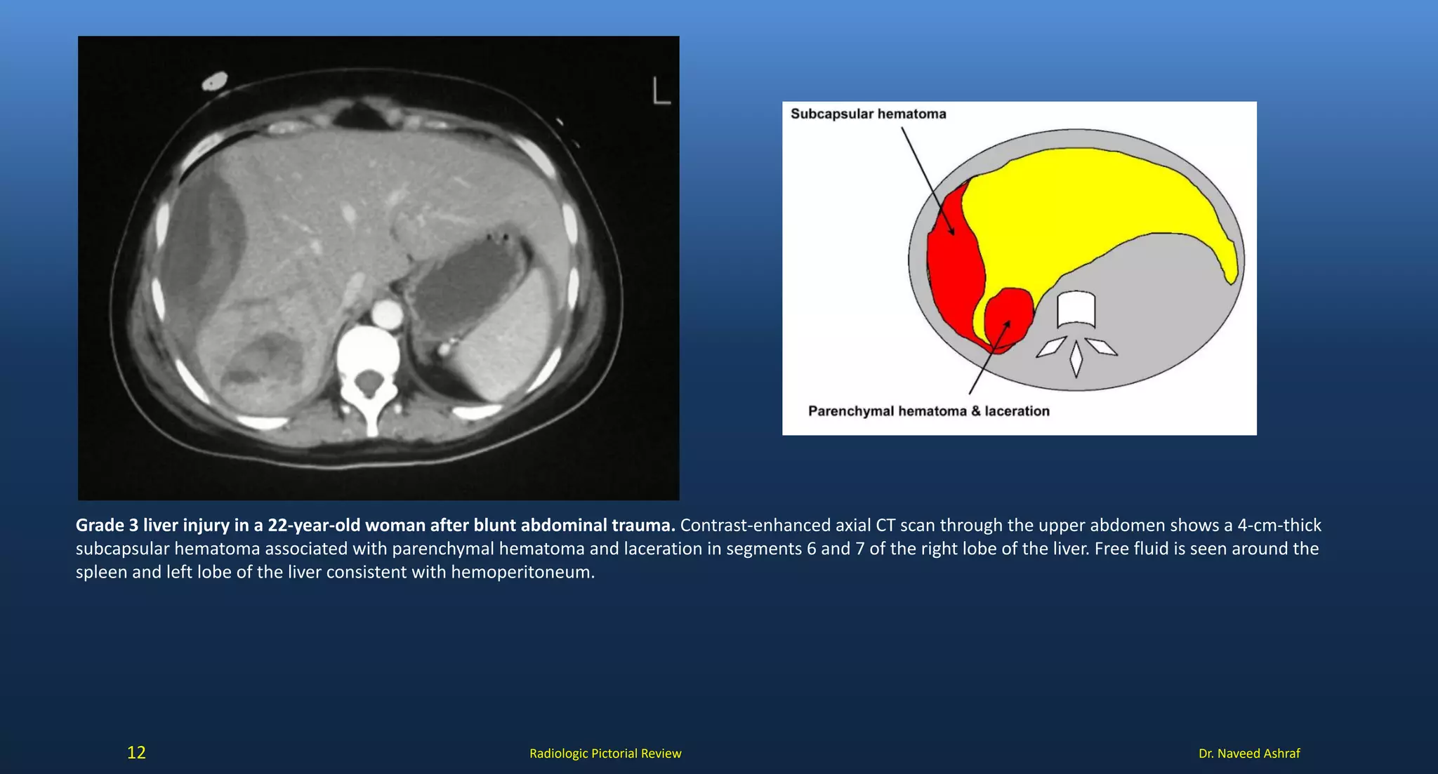 Liver trauma | PDF