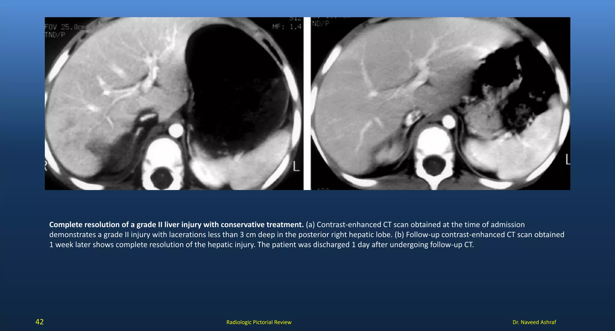 Liver trauma | PDF