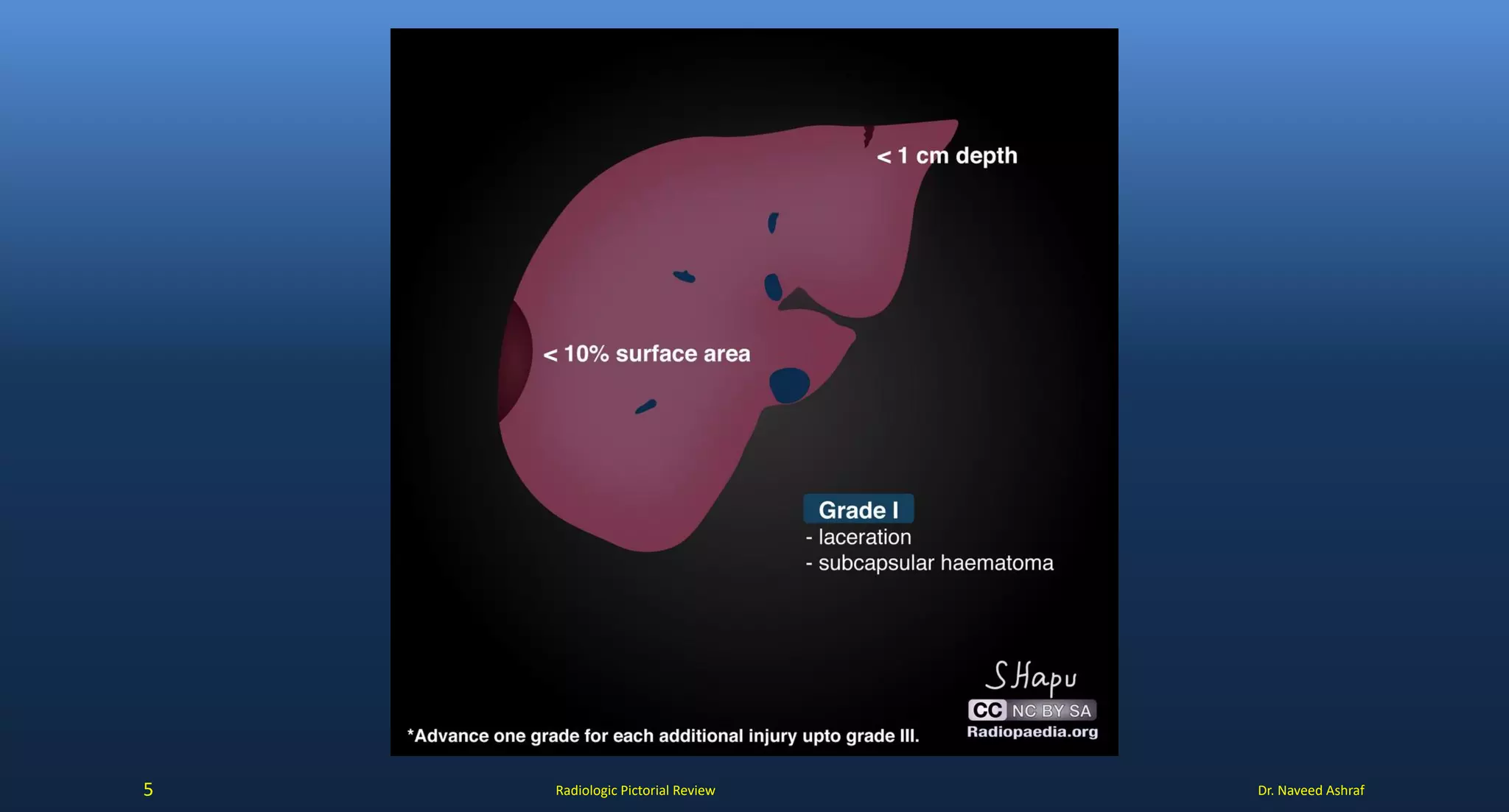 Liver trauma | PDF