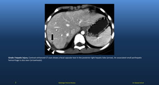 Liver trauma | PDF