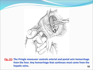 Liver trauma | PPT