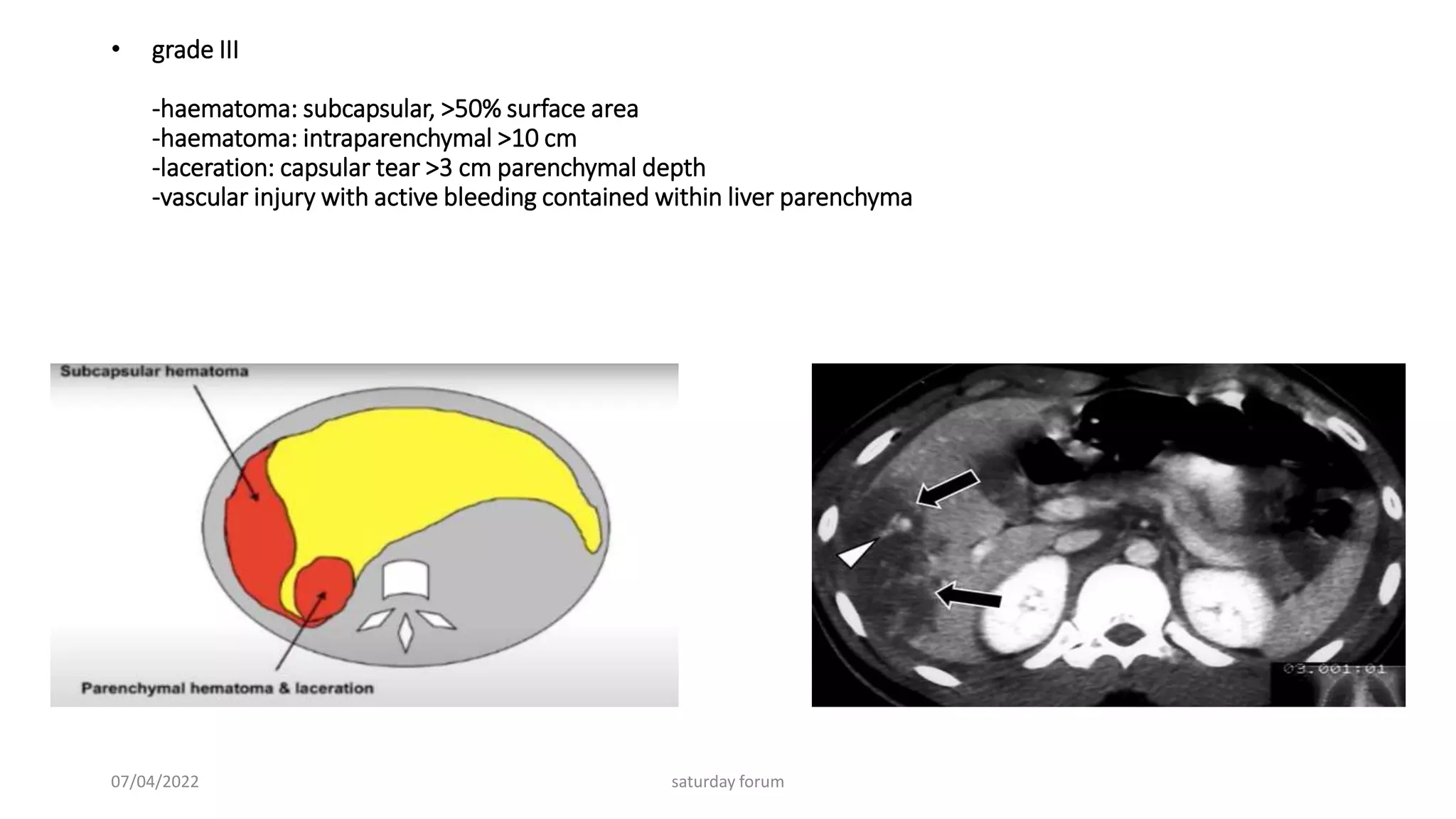 liver trauma.pptx