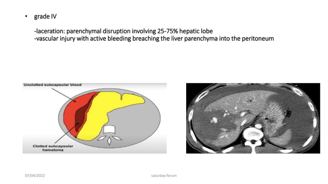 liver trauma.pptx