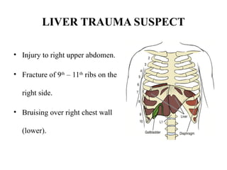 LIVER INJURY: A BRIEF SURGICAL MANAGEMENT | PPTX