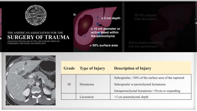 Liver Trauma - World Journal of Emergency Surgery.pptx