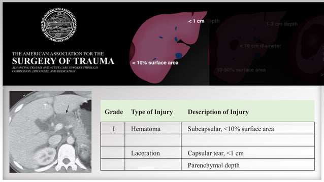 Liver Trauma - World Journal of Emergency Surgery.pptx