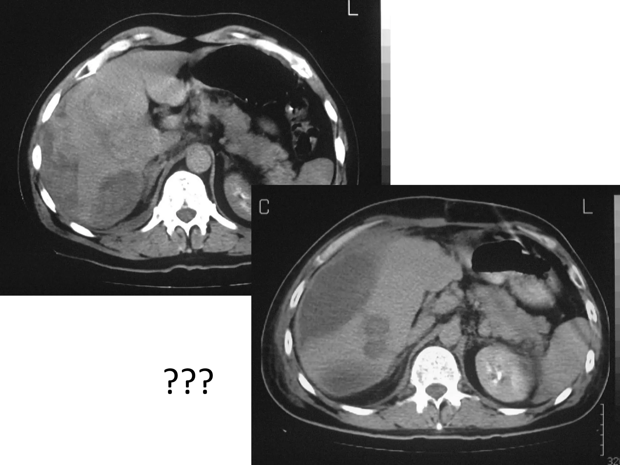 Liver Trauma (Liver Injury) | PPT