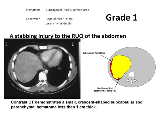 Liver Trauma (Liver Injury) | PPT