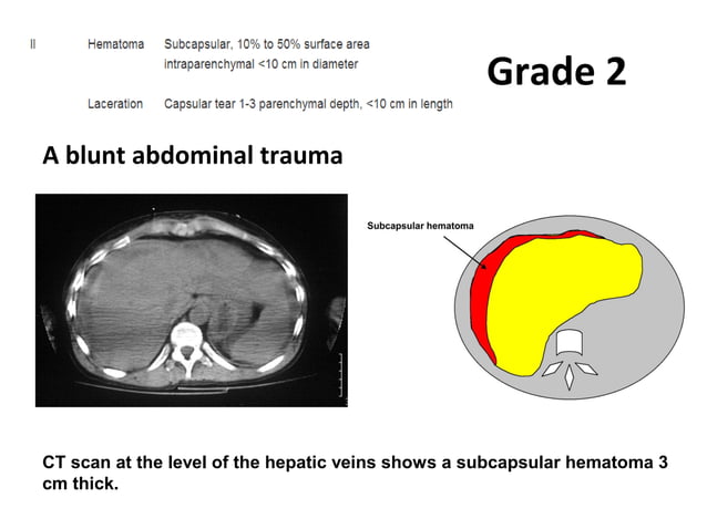 Liver Trauma (Liver Injury) | PPT