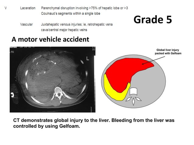 Liver Trauma (Liver Injury) | PPT