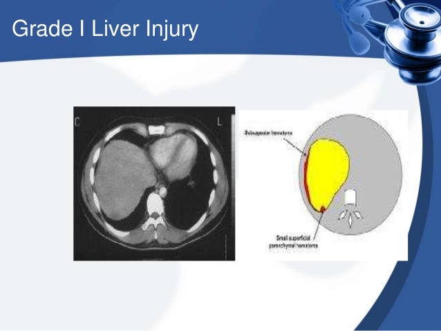 Liver trauma final