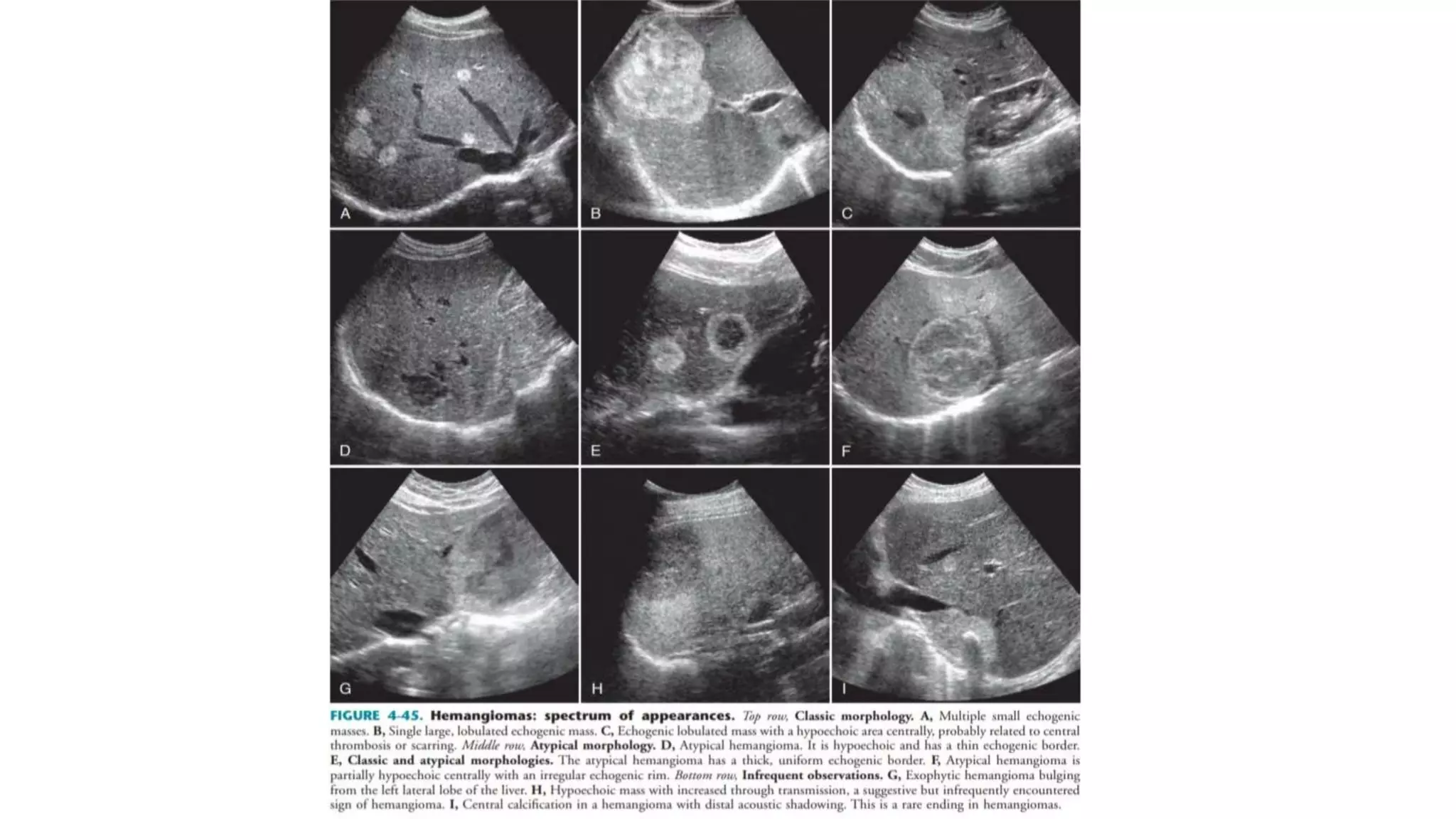Ultrasonography of hepatic mass lesion | PPTX | Blood Disorders ...