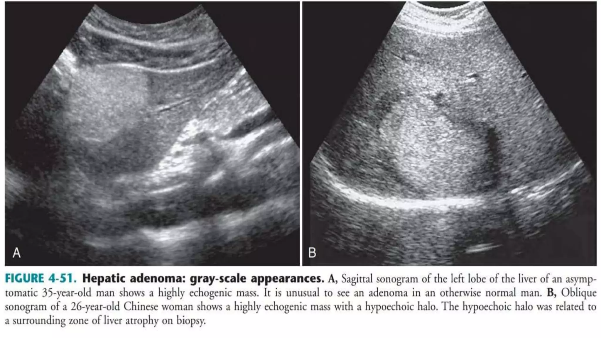 Ultrasonography of hepatic mass lesion | PPTX | Blood Disorders ...
