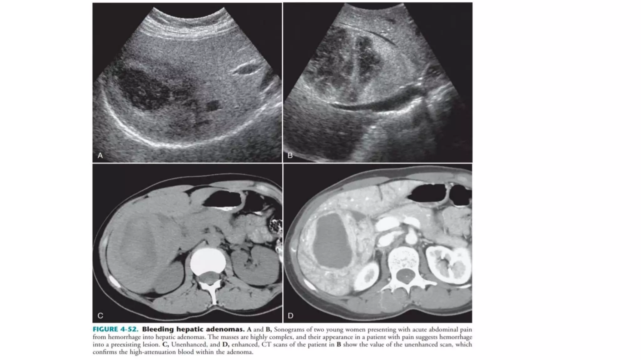 Ultrasonography of hepatic mass lesion | PPTX | Blood Disorders ...
