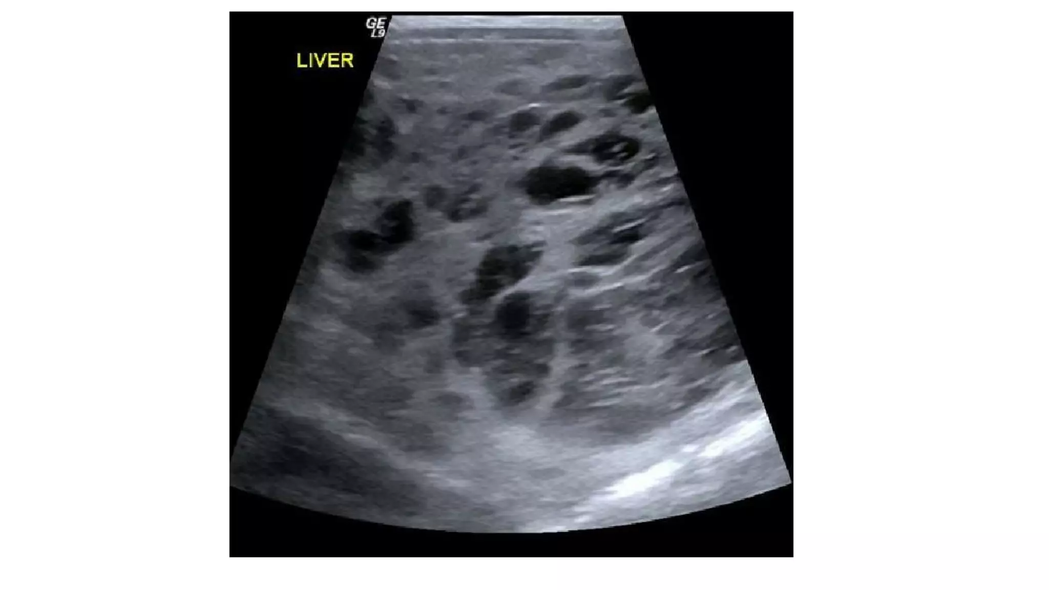 Ultrasonography of hepatic mass lesion | PPTX