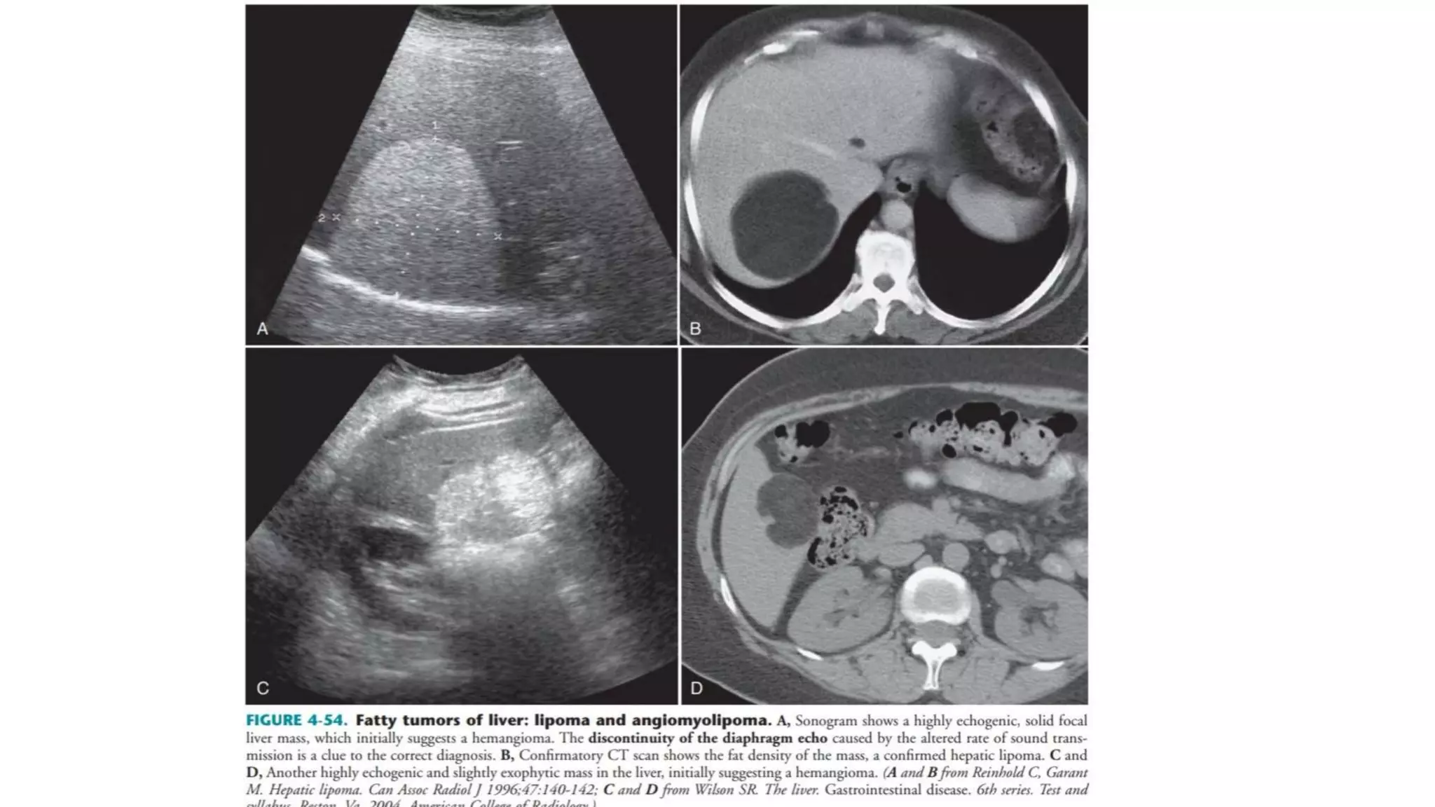 Ultrasonography of hepatic mass lesion | PPTX | Blood Disorders ...