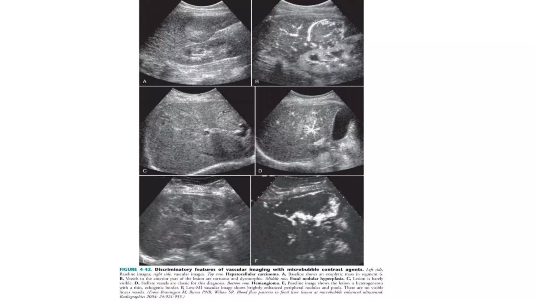 Ultrasonography of hepatic mass lesion | PPTX