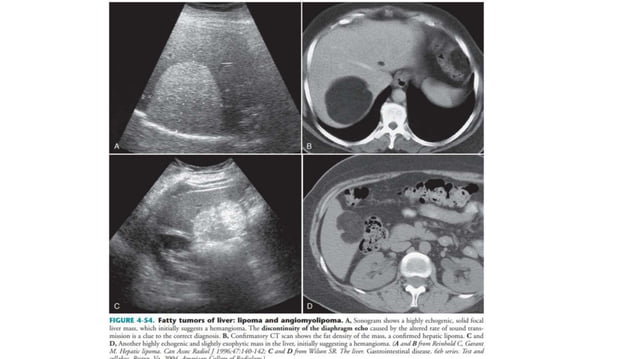 Ultrasonography of hepatic mass lesion | PPTX | Blood Disorders ...