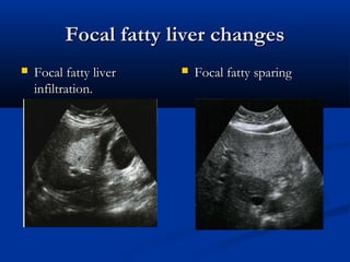 Liver ultrasound | PPT