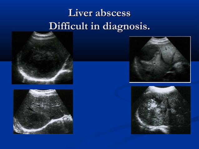 Liver ultrasound