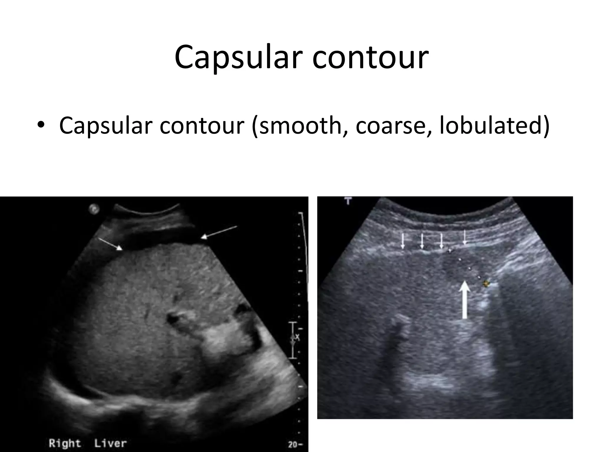 liver ultrasound.pptx