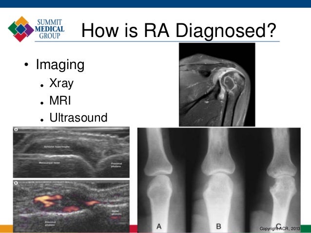Living with Rheumatoid Arthritis