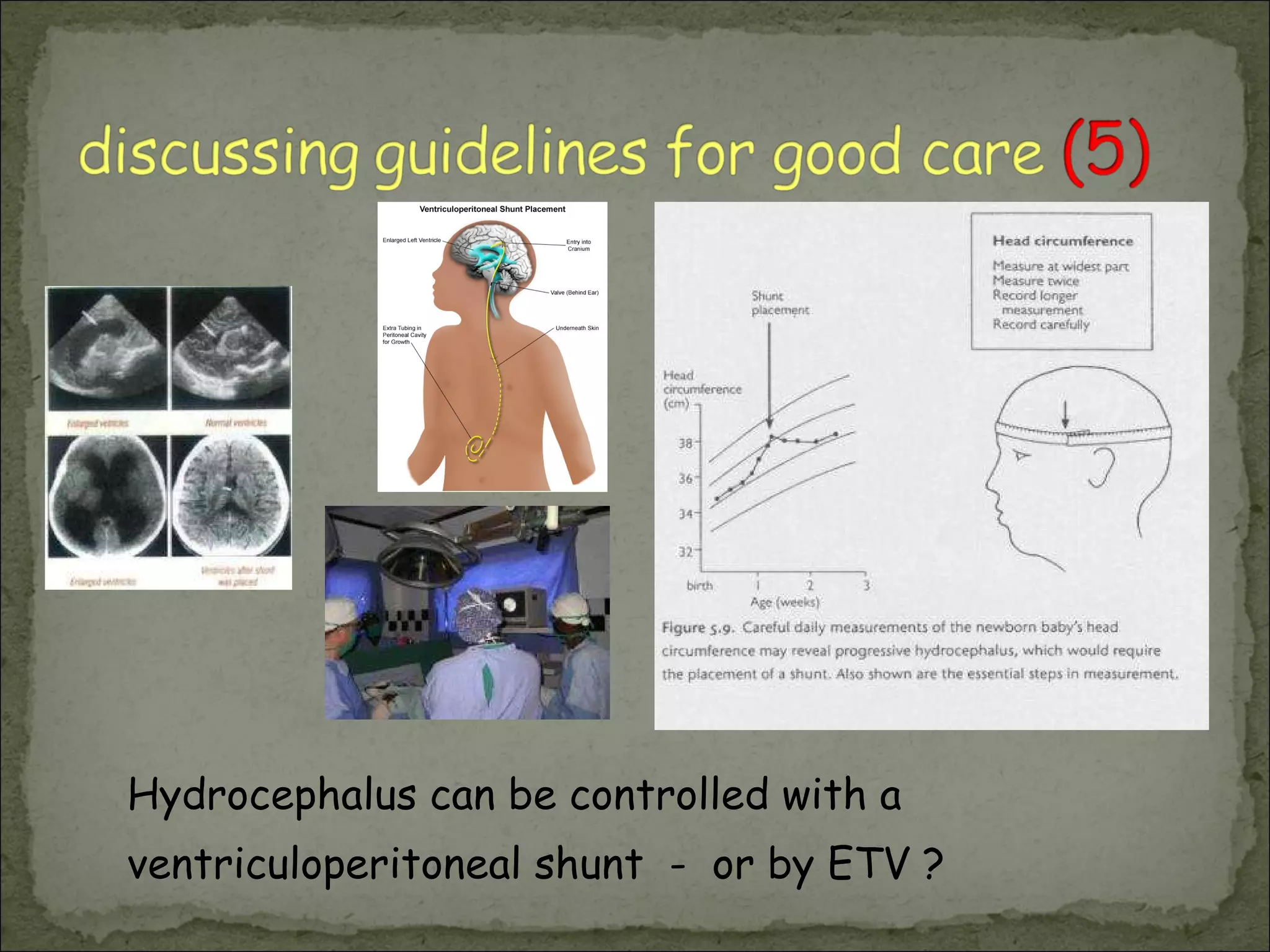 Living with spina bifida and hydrocephalus in developing countries ...