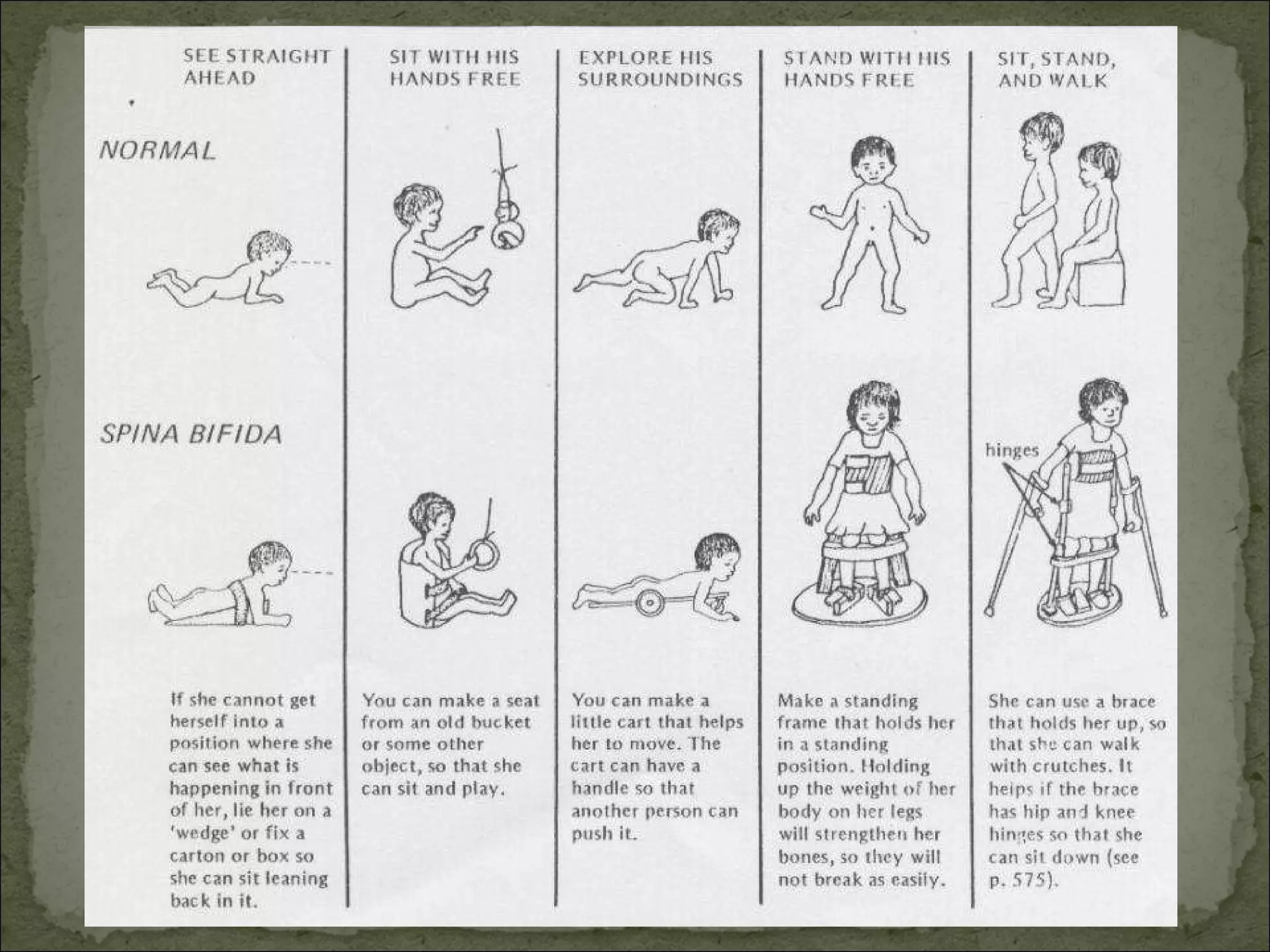 Living with spina bifida and hydrocephalus in developing countries ...