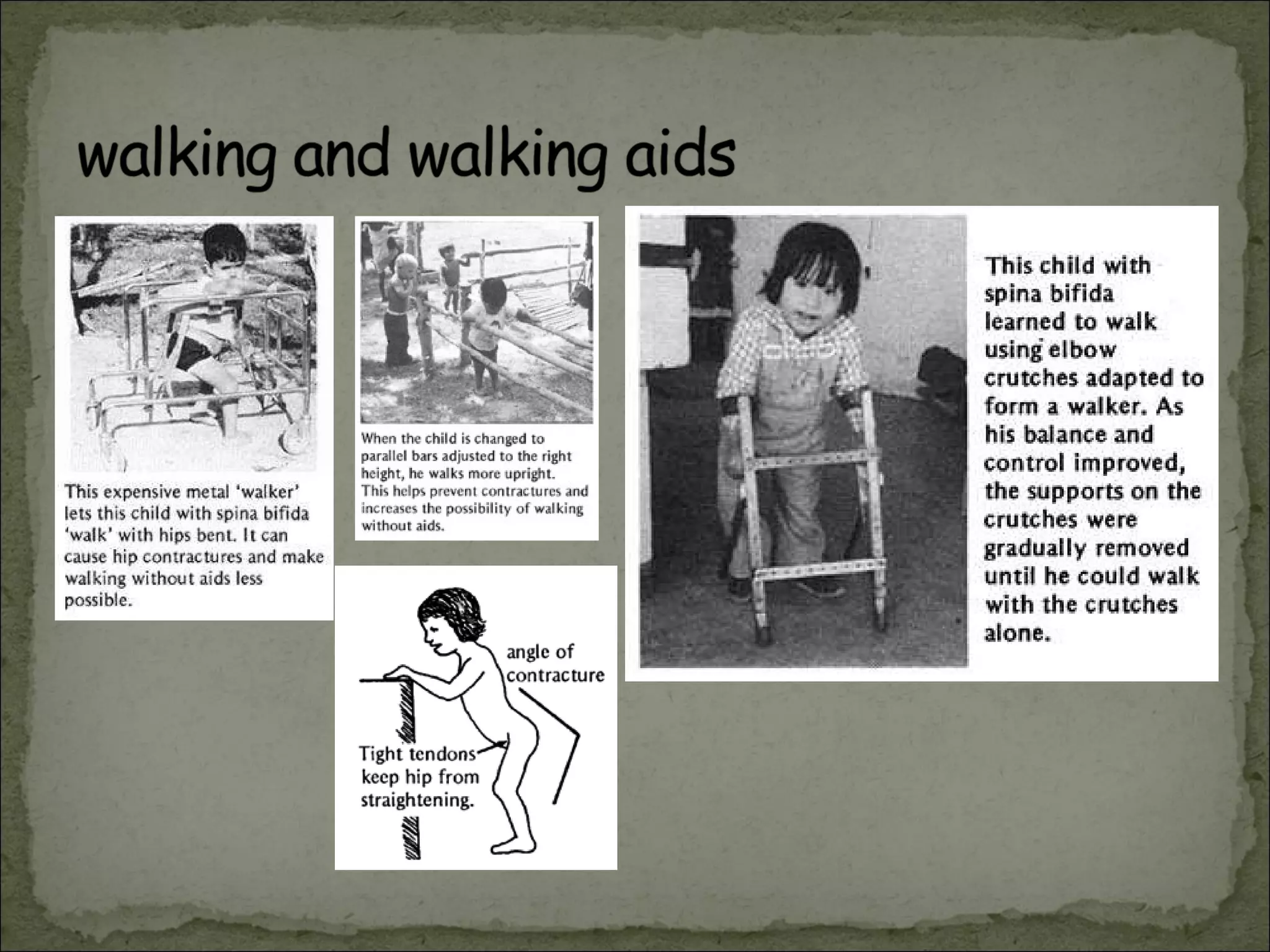 Living with spina bifida and hydrocephalus in developing countries ...